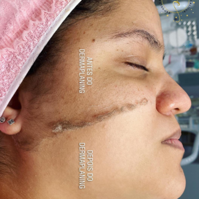 Para que serve o Dermaplaning? Especialista explica tudo